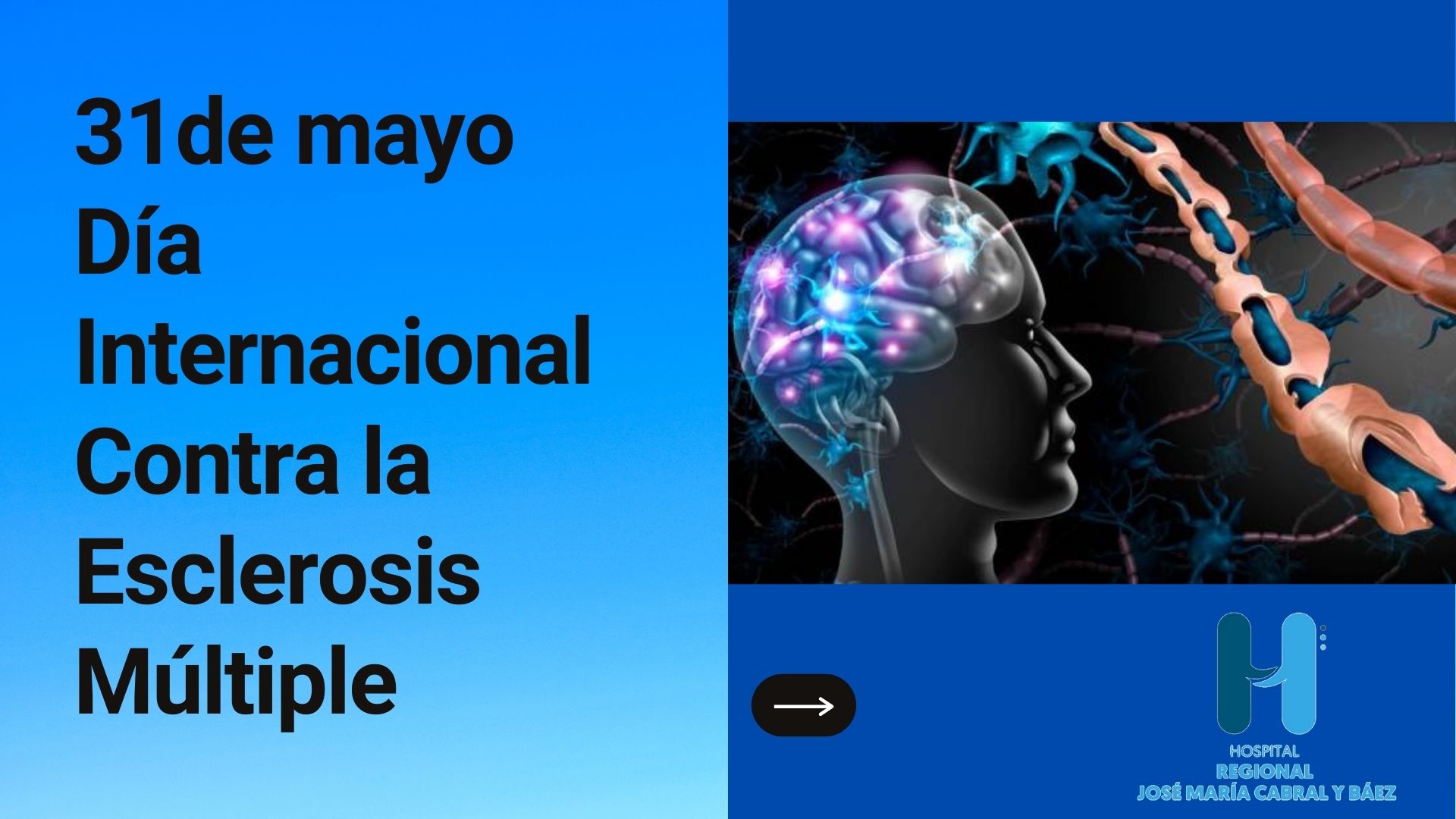 Esclerosis múltiple - Hospital Cabral y Baez